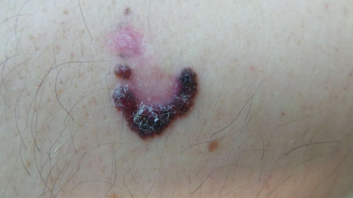 Melanoma: Diagnosis and Treatment | Dermatology Clinic Dermadvance